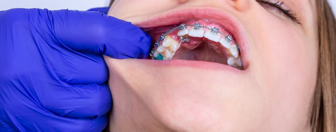 Expose and Bond - SF Bay Oral Surgery | Oral Surgeons, Maxillofacial ...