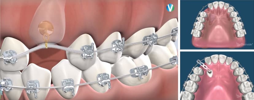 Expose and Bond - SF Bay Oral Surgery | Oral Surgeons, Maxillofacial ...