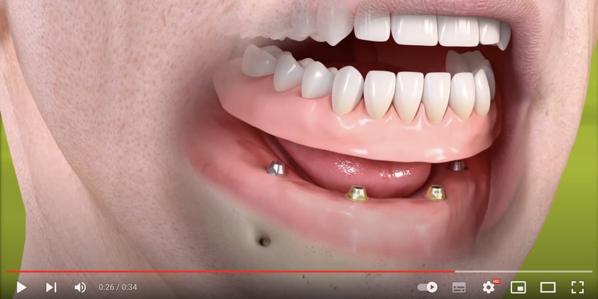 Full Arch Restoration - SF Bay Oral Surgery | Oral Surgeons ...