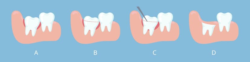 Wisdom Teeth Surgery - SF Bay Oral Surgery | Oral Surgeons ...